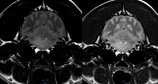 Meningo-encephalomyelitis of Unknown Origin (MUO) - Southfields