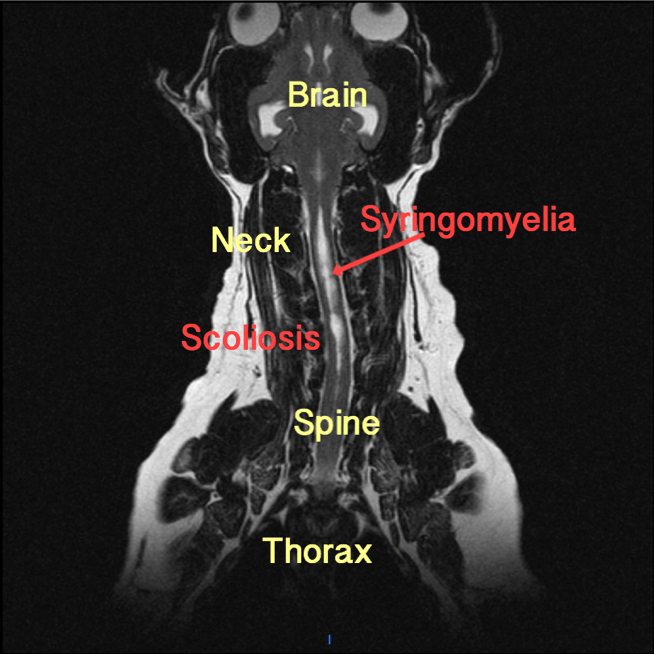 Chiari-like Malformation and Syringomyelia - Southfields