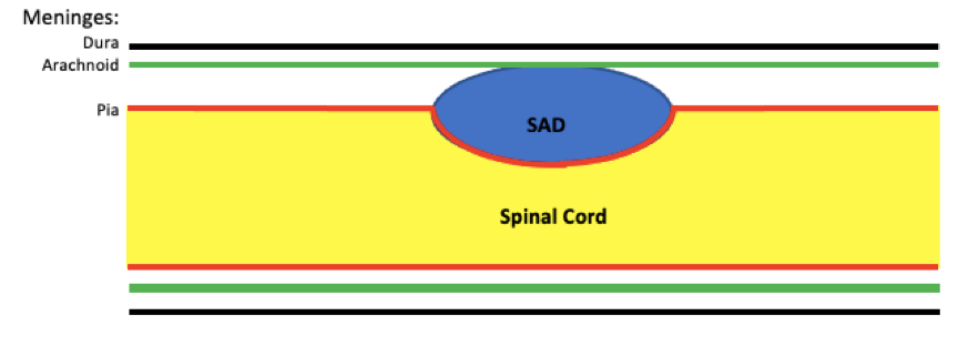 Spinal Arachnoid Diverticulum (SAD) - Southfields