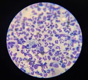Steroid-responsive Meningitis Arteritis (SRMA) - Southfields
